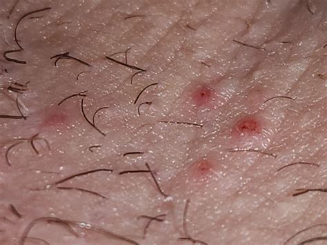Folliculitis Genital Area Women Bilateral Axillary Folliculitis Due To