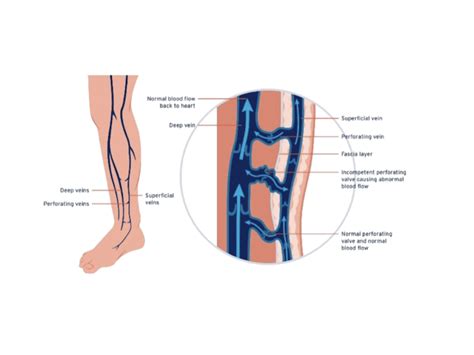 Venous Leg Ulcers How To Recognize And Treat Them Jobst Uk