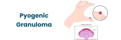 Pyogenic Granuloma Causes Symptoms Diagnosis And Treatment