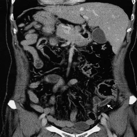 Acute Appendicitis In Situs Inversus Totalis Journal Of The American College Of Surgeons