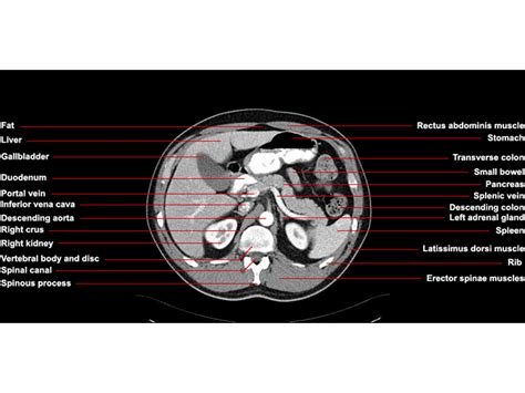 Ct Of The Abdomen Axial Anatomy Radiologypicscom
