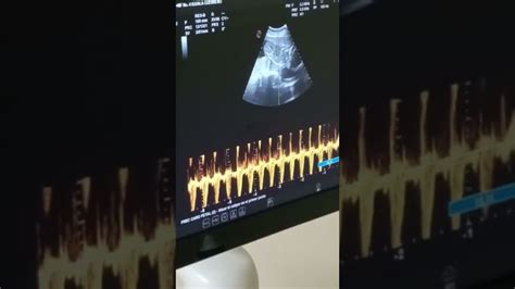 ultrasonido confirman el sexo del bebé YouTube