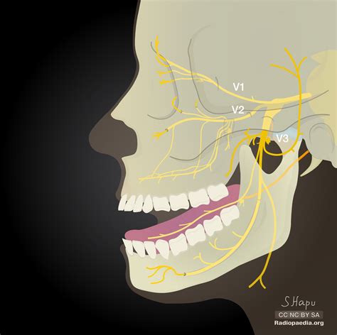 Radiopaedia Drawing Main Branches Of The Trigeminal Nerve English Labels Anatomytool