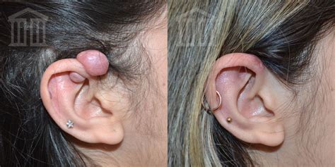 Before And After Ear Keloid Removal