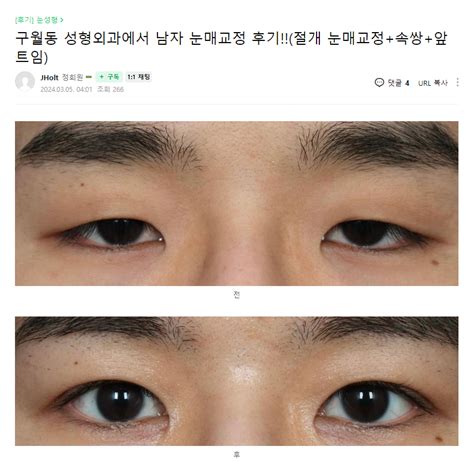 구월동 성형외과에서 남자 눈매교정 후기 절개 눈매교정 속쌍 앞트임 고객후기