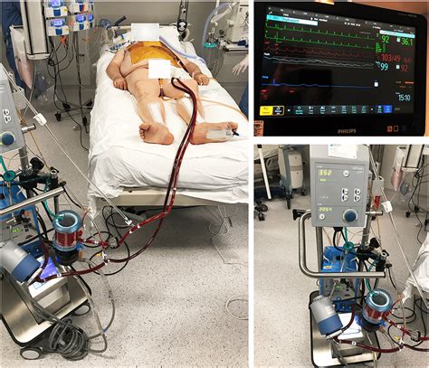 The Patient With High‐risk Pe Showing Hemodynamic Collapse Who Were Download Scientific