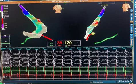 三维标测下的室速射频消融手术，是近年逐渐发展起来的新技术，目前国内只有少数三级大型医院可以实现，射频消融在治疗室上速、房颤、房速，室早、室速等心律失常方面有很多优势，比起药物治疗，射频消融术