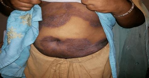 Tinea Corporis Waist And Inframammary Area Download Scientific Diagram