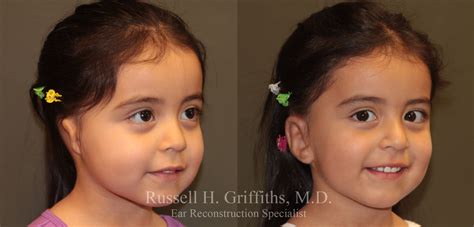 Case 4 One Stage Microtia Reconstruction Medpor Before And After