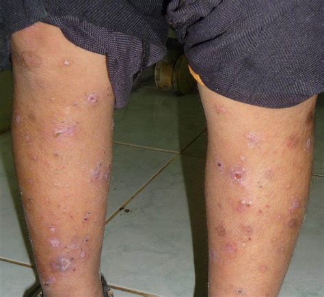 Scabies On Legs