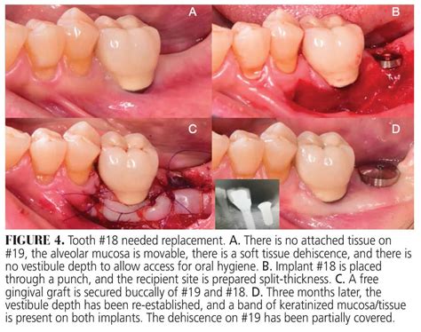 Clinical Applications Of Soft Tissue Augmentation Around Implants Decisions In Dentistry