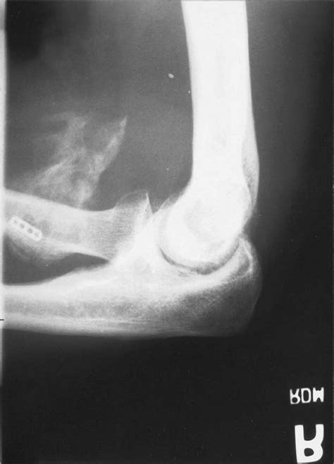 Heterotopic Ossification Of The Biceps Tendon On Lateral Radiograph