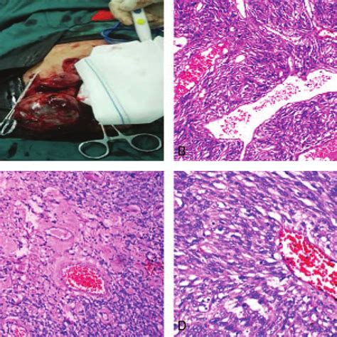 Surgical And Pathological Features A Two Tumor Nodules At Right