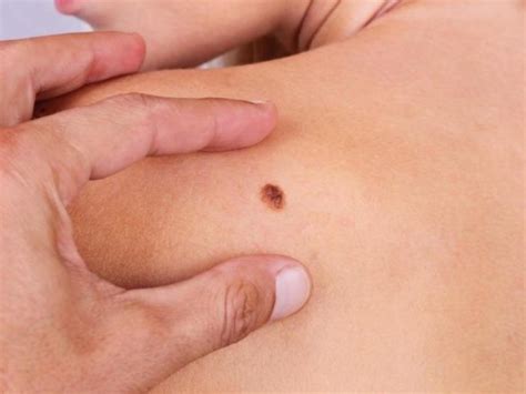 Día Mundial Contra El Melanoma
