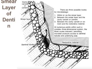 The Smear Layer Pptx