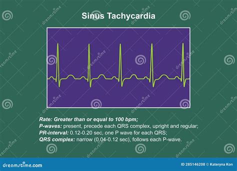 Electrocardiogram Displaying Supraventricular Tachycardia 3d