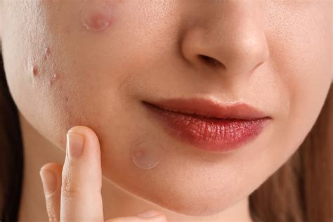 Best Pimple Patches Options For Every Acne Scenario Acne Club