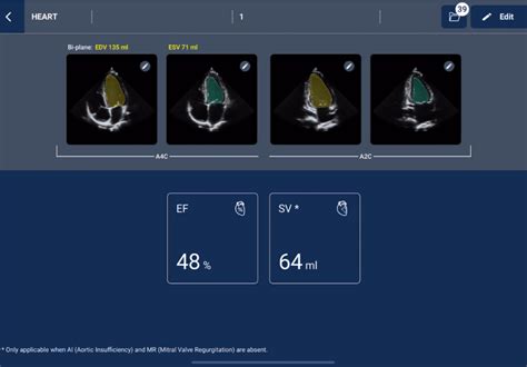 Kosmos Ai Ef Clinical Validation Document Download Echonous