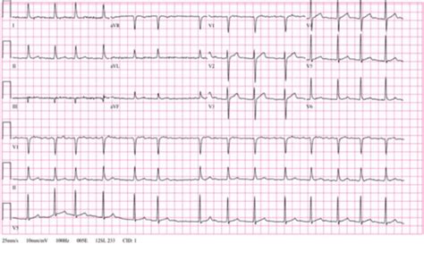 Afib Aflutter Flashcards Quizlet