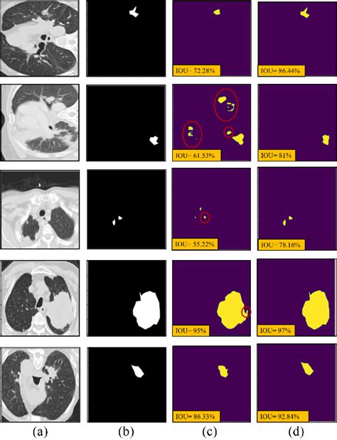 Figure 1 From Pulmonary Nodule Segmentation Framework Based On Fine Tuned And Pretrained Deep