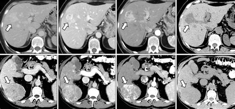 Hepatocellular Carcinoma Hcc Versus Intrahepatic Cca Icca On Download Scientific Diagram