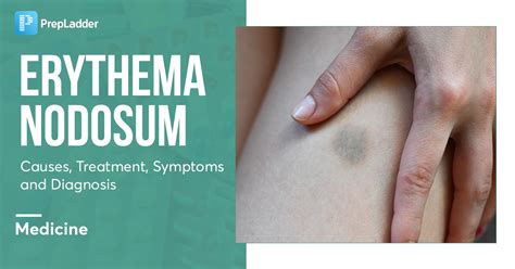 Erythema Nodosum Causes Symptoms Diagnosis And Treatment