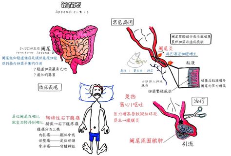 【科普】医学手绘动画 急性阑尾炎手术