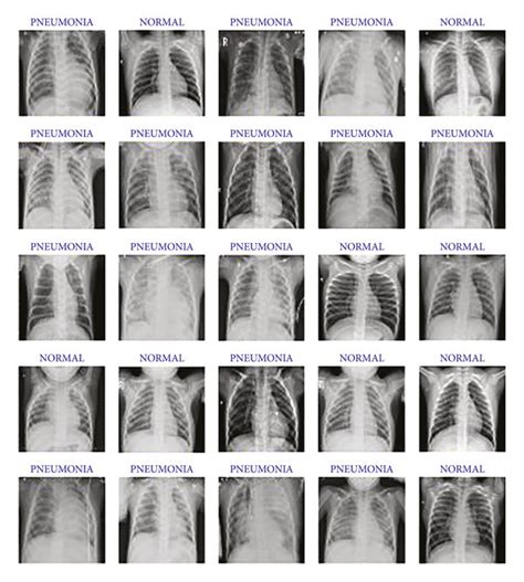 Some Images From Kaggles Pneumonia Dataset Download Scientific Diagram