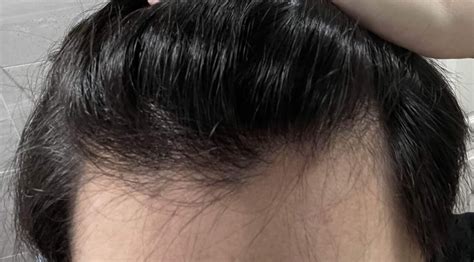 블라인드 블라블라 두피 붉은끼는 탈모 전조 증상 블라인드 블라블라 두피 붉은끼는 탈모 전조 증상