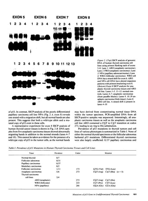 High Prevalence Of Mutations Of The P53 Gene In Poorly Differentiated Human Thyroid Carcinomas Pmc