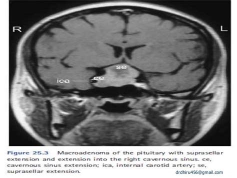 Transsphenoidal Hypophysectomy By Drdhiru456