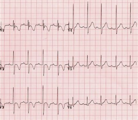 T Wave • Litfl • Ecg Library Basics