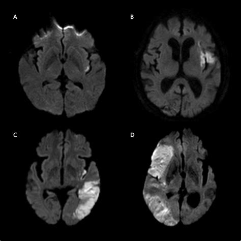 Patterns Of Insular Involvement In Ischemic Stroke High Signal