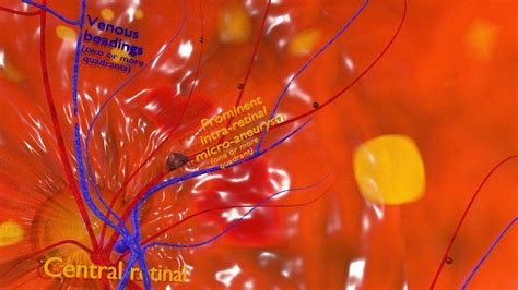 Diabetic Eye Diseases Model Superhive Formerly Blender Market