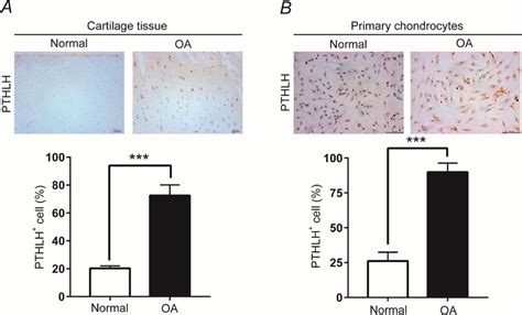 Increased PTHLH Expression In B OA Cartilage And B OA Chondrocytes The