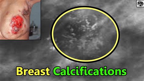 Breast Calcifications Types And Causes Of Breast Calcifications Youtube