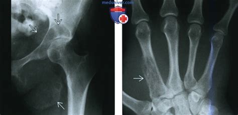 Рентгенограмма КТ МРТ при гигантоклеточной опухоли