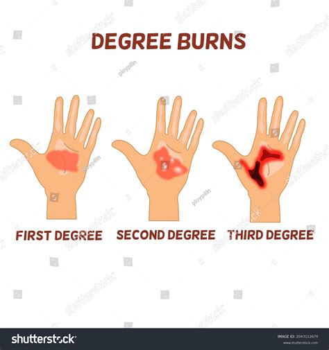 First Degree Burn Hand
