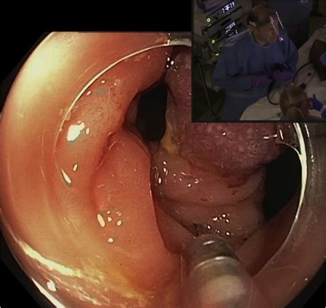 Figure 3 From Endoscopic En Bloc Removal Of Appendiceal Polyp