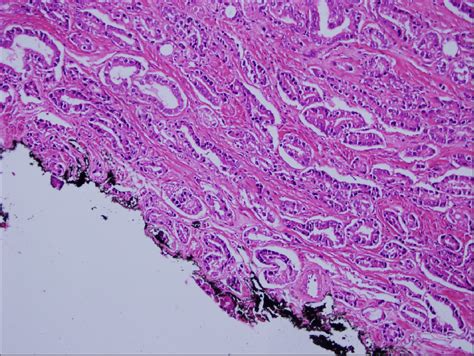 Tumor Reaches The Inked Surgical Margin Hande X200 Figure 2 Tumor