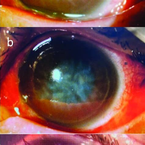 A A Case With Anterior Segment Ischemia After Xt Combined With So And A A Case With Anterior Segment Ischemia After Xt Combined With So And