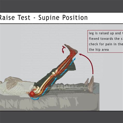Medical Legal Exhibits Legal Animations And Trial Graphics Tria