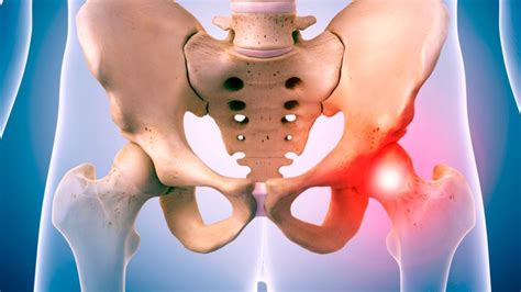 What Is Degenerative Osteoarthritis Of The Hip