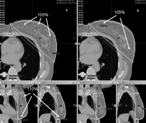 Isodose Distribution For A Typical Patient For Three Dimensional