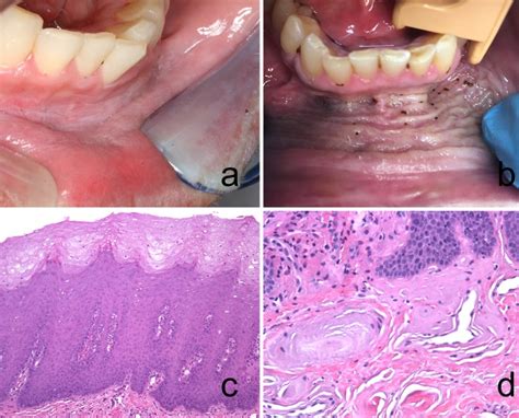 Frictional Keratosis Cheek