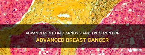 Advancements In Diagnosis And Treatment Of Advanced Breast Cancer Medshun
