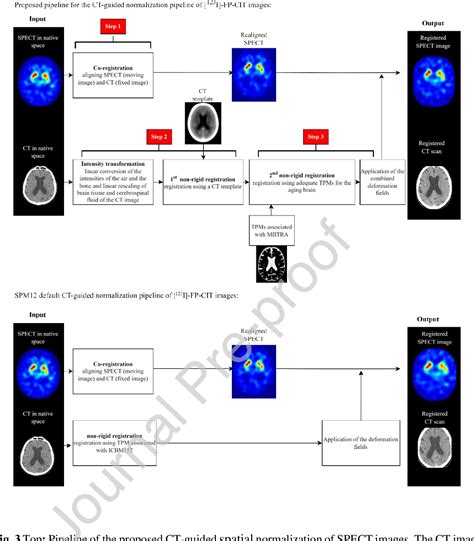 Figure 1 From Ct Guided Spatial Normalization Of Nuclear Hybrid Imaging Adapted To Enlarged