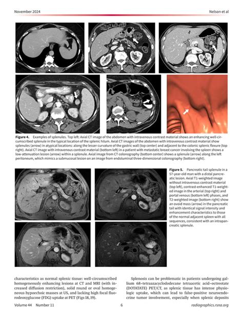 Nelson Et Al 2024 Spectrum Of Heterotopic And Ectopic Splenic Conditions Pdf