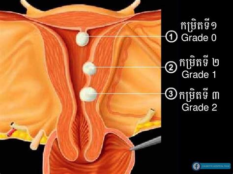 សូមស្វែងយល់ អំពី ជំងឺដុំសាច់នៅភ្នាសក្នុងនៃស្បូន សារព័ត៌មាន នគរវត្ត