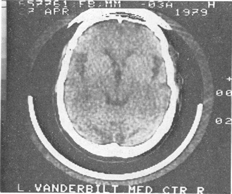 CTscan Case 3 Showing Only Generalised Cortical Atrophy No Focal Download Scientific Diagram